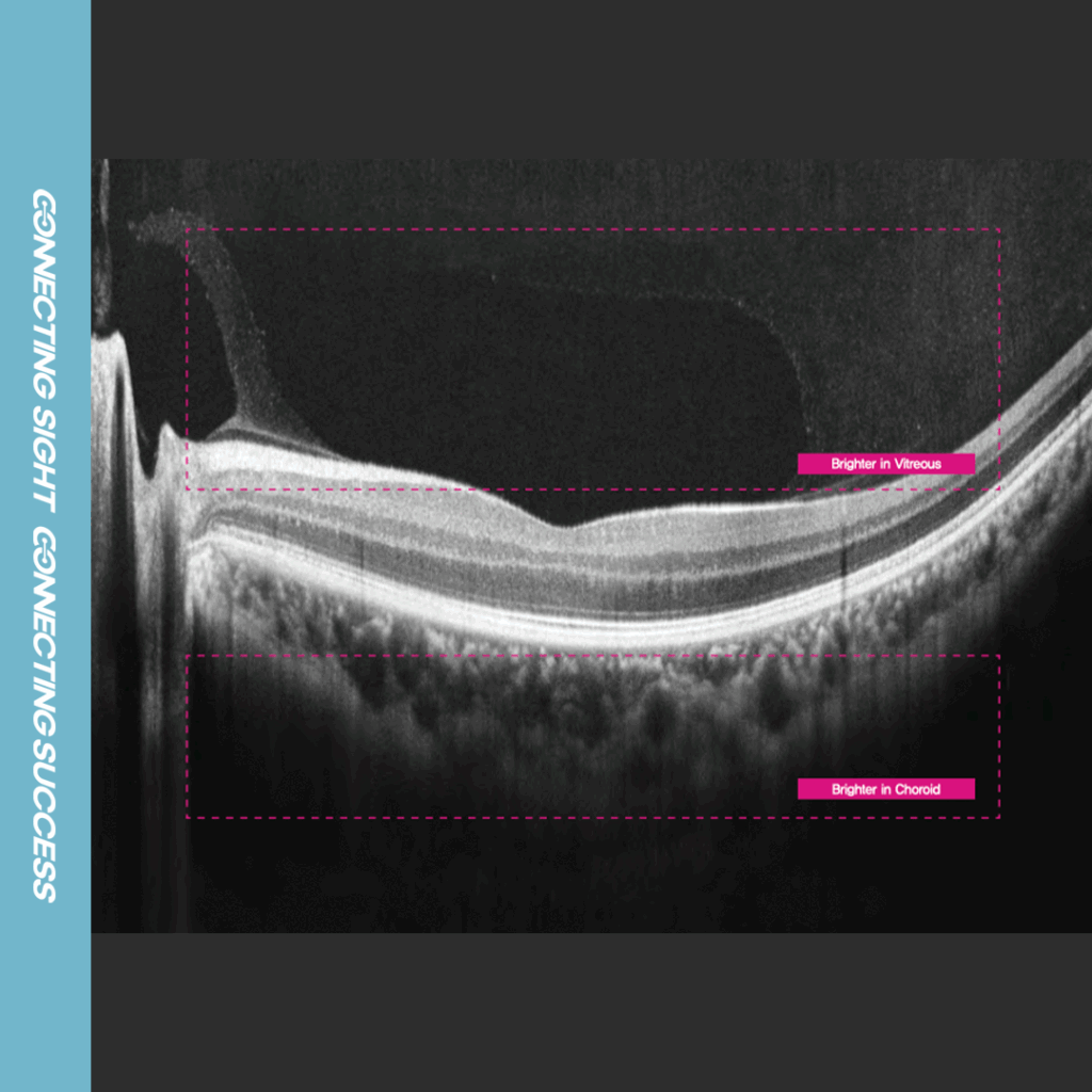 OCT Scan with OCTavius, 5 Key Functions | Latest-Ophthalmology ...