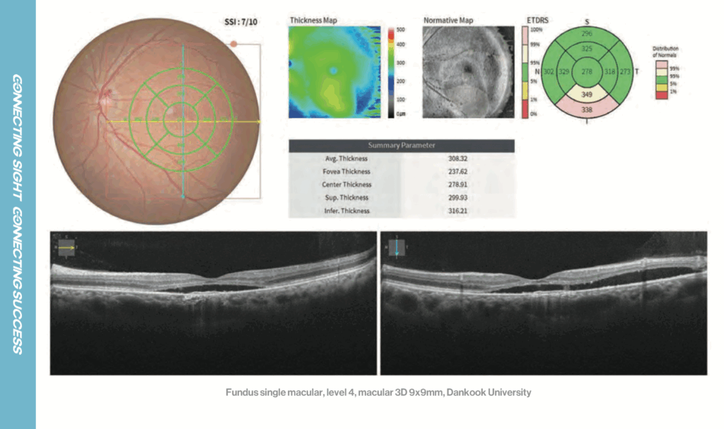 True Color Retinal Imaging with OCTavius Fundus Camera | Latest ...