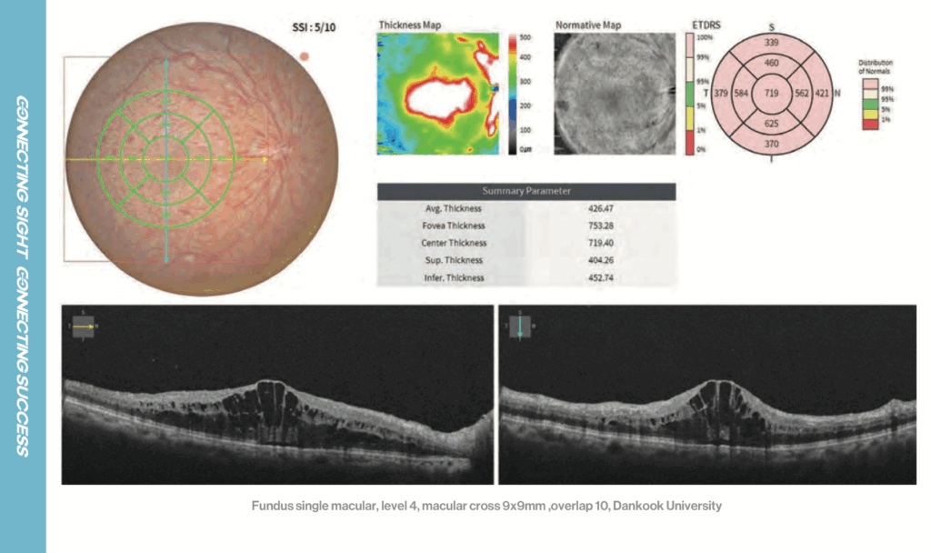 True Color Retinal Imaging with OCTavius Fundus Camera | Latest ...