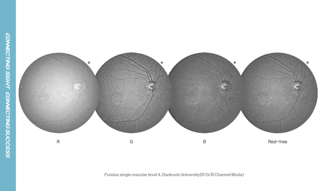 True Color Retinal Imaging with OCTavius Fundus Camera | Latest ...